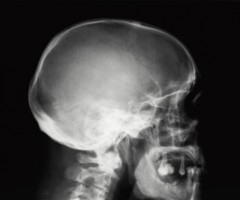 Birth Defects Due to Harmful Chemicals | Toxic Exposure