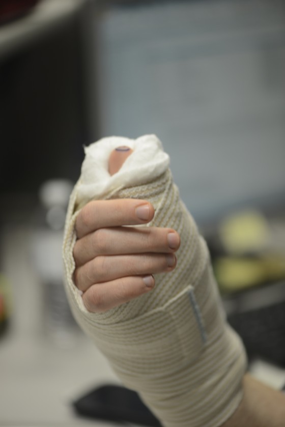Broken Finger | Fractured Thumb | Orthopedic Injury Lawyer